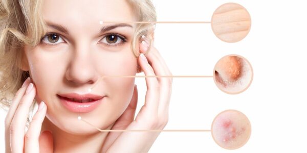 Acne, Pits & Scars - Health Sanctuary