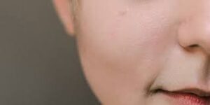 Blemishes - Health Sanctuary