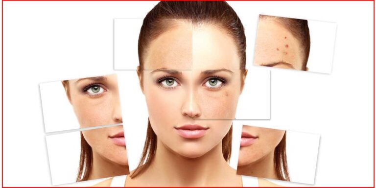 Hyper-Pigmentation - Health Sanctuary