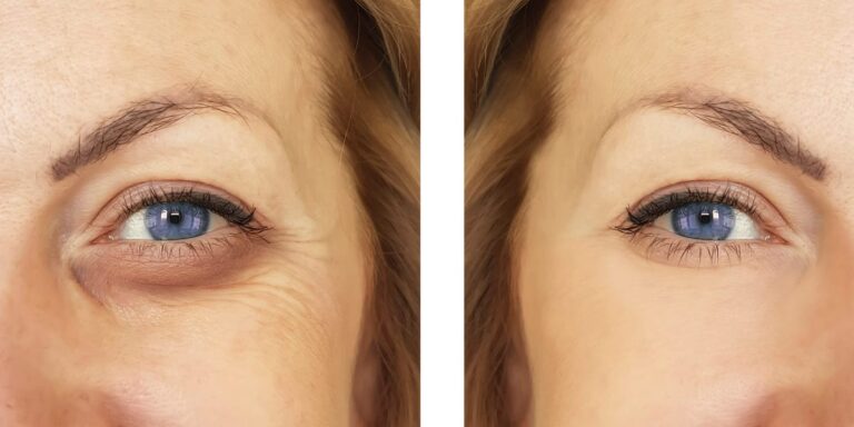 Under Eye Puffiness Treatment - Health Sanctuary